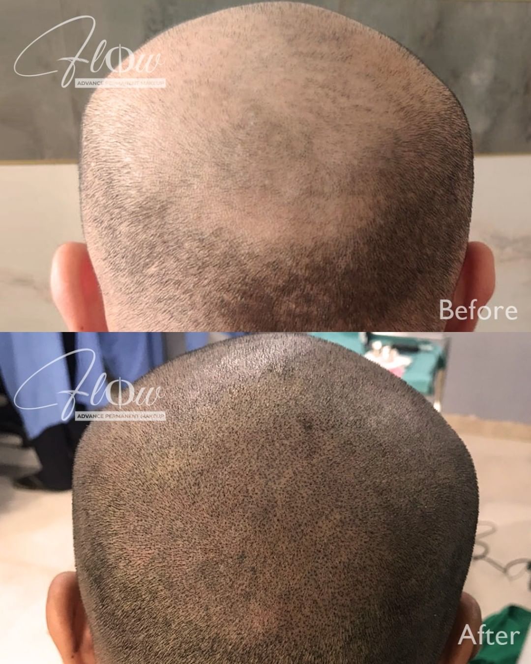 All You Need To Know About Scalp-micro Pigmentation - Flow PMU